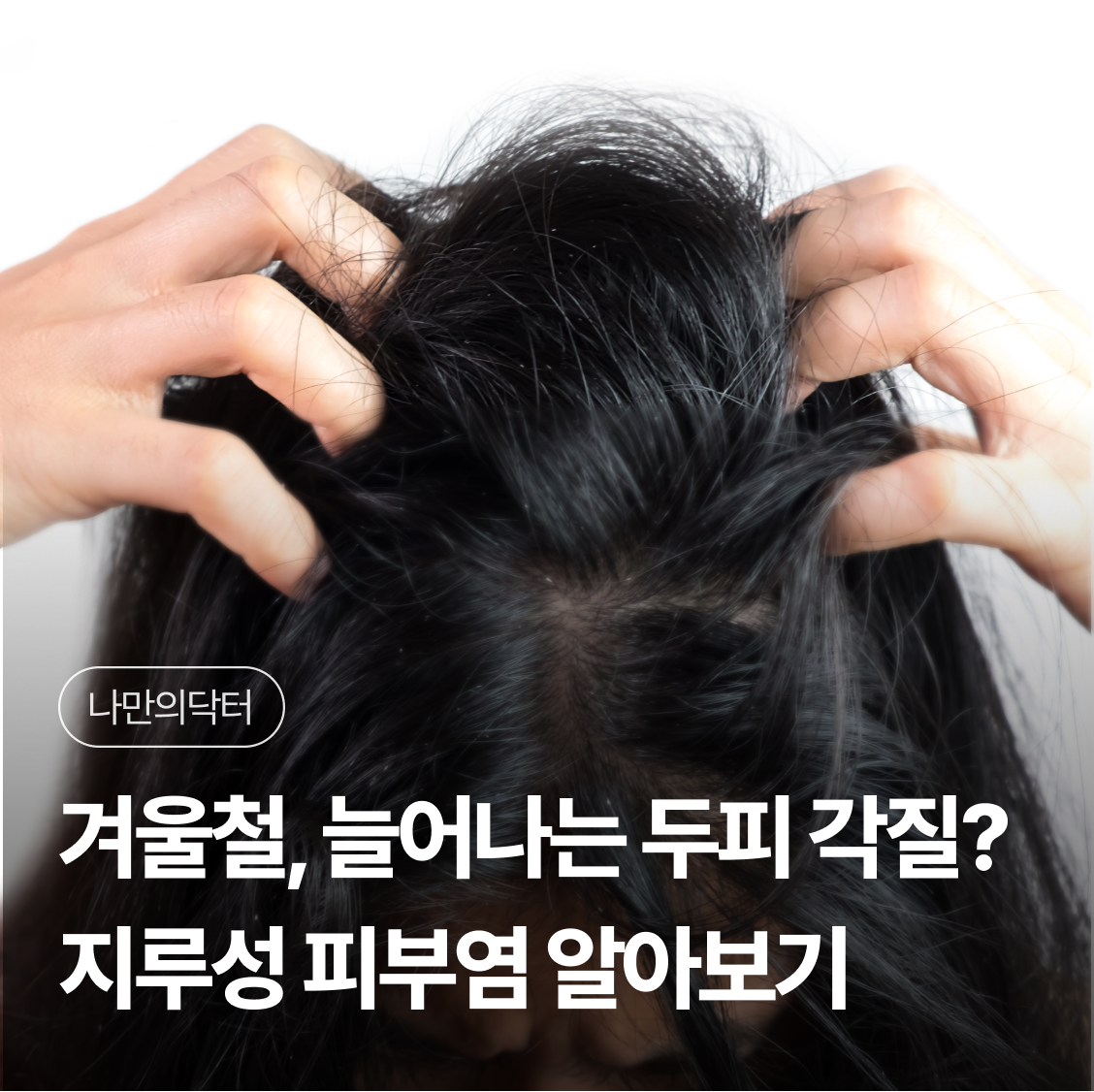 지루성 피부염 원인 증상 치료법 예방법 알아보기🧐 나에게 딱 맞는 건강 꿀팁